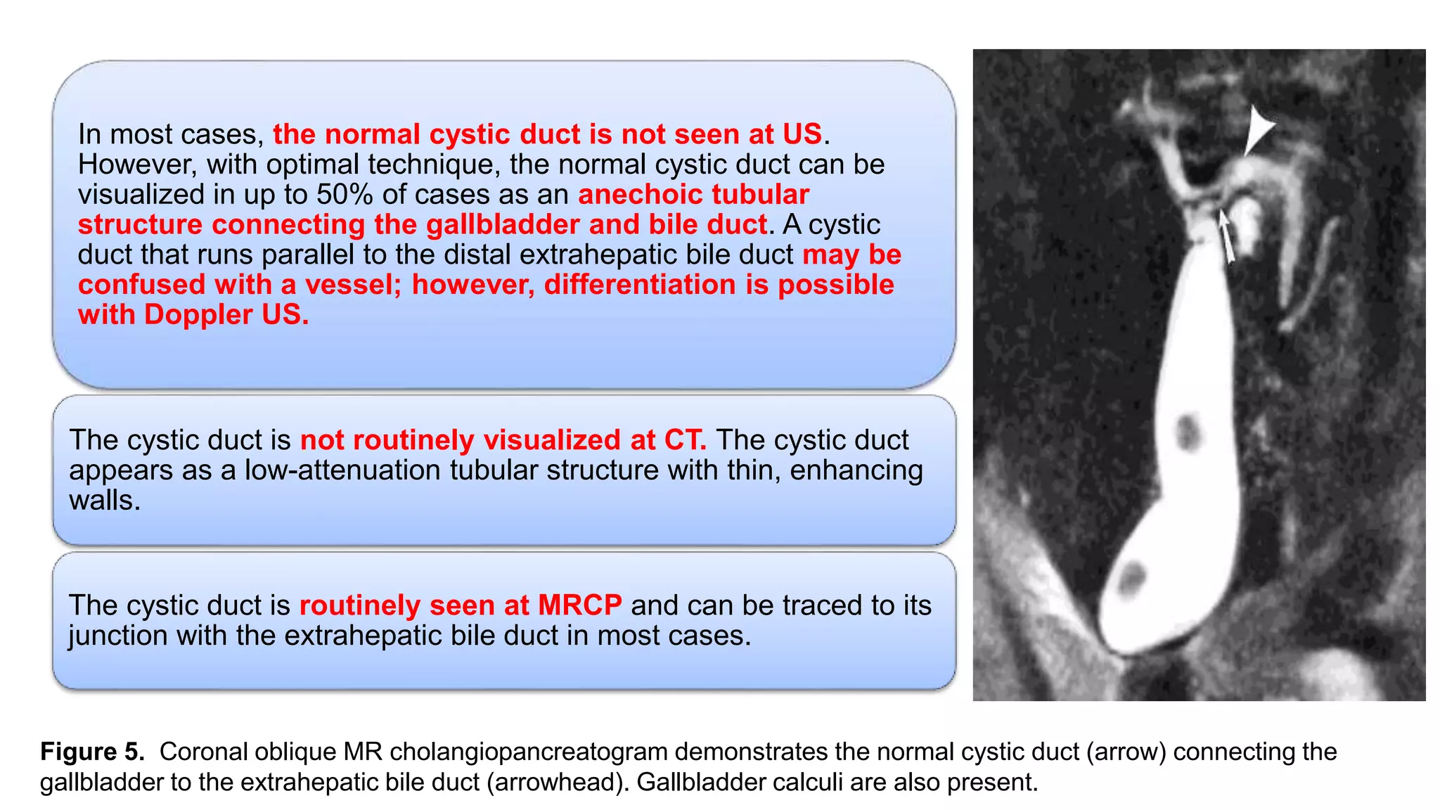 Cystic Duct Normal Anatomy and Anatomic Variants.pptx