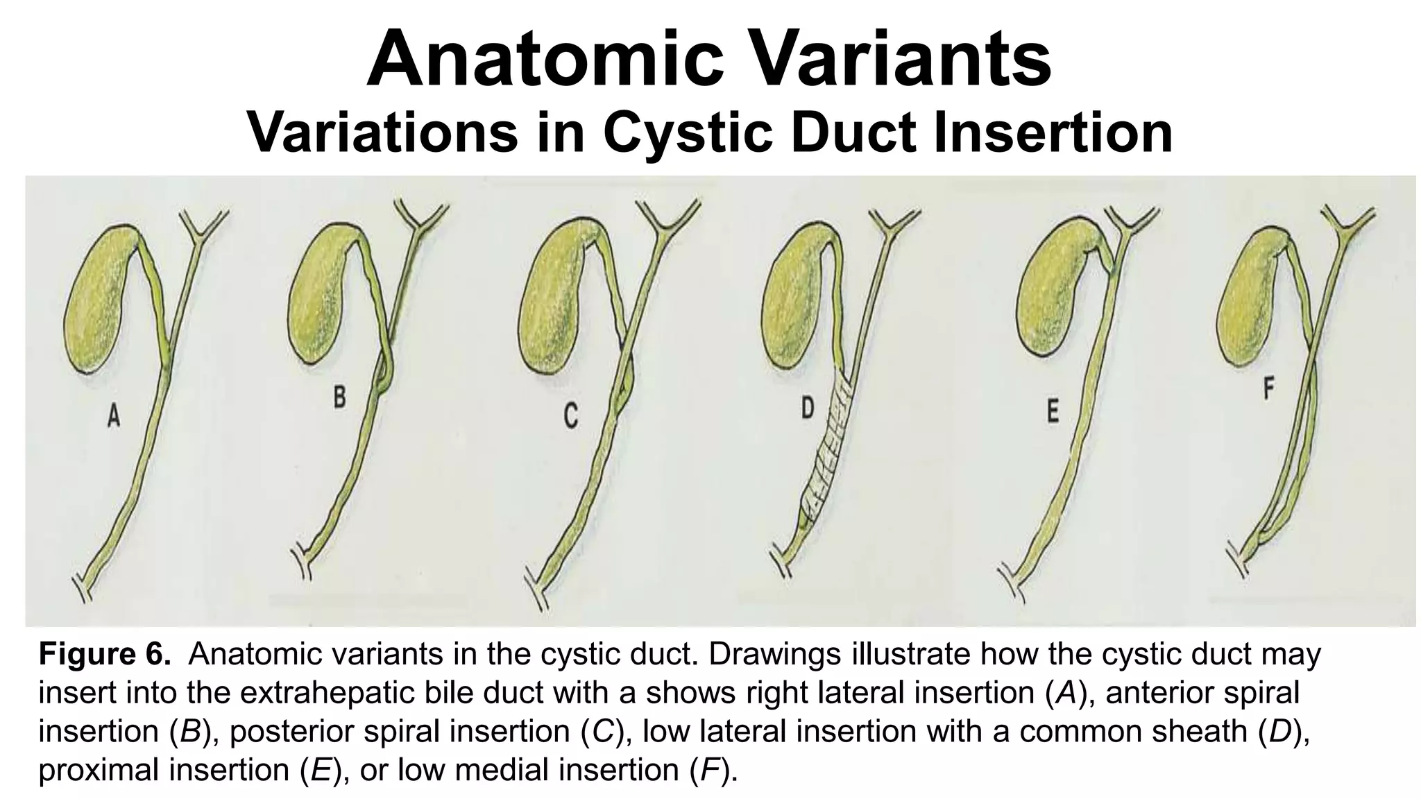 Cystic Duct Normal Anatomy and Anatomic Variants.pptx