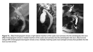 Cystic Duct Normal Anatomy and Anatomic Variants.pptx