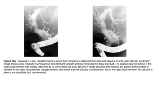 Cystic Duct Normal Anatomy and Anatomic Variants.pptx