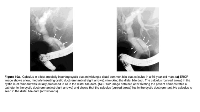 Cystic Duct Normal Anatomy and Anatomic Variants.pptx