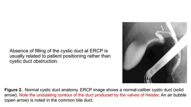 Cystic Duct Normal Anatomy and Anatomic Variants.pptx | Digestive ...