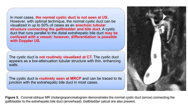 Cystic Duct Normal Anatomy and Anatomic Variants.pptx | Digestive ...