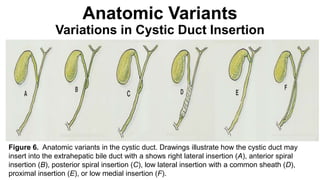 Cystic Duct Normal Anatomy and Anatomic Variants.pptx