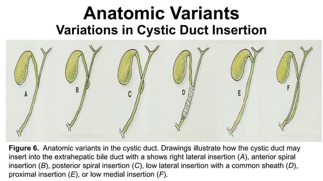 Cystic Duct Normal Anatomy and Anatomic Variants.pptx | Digestive ...