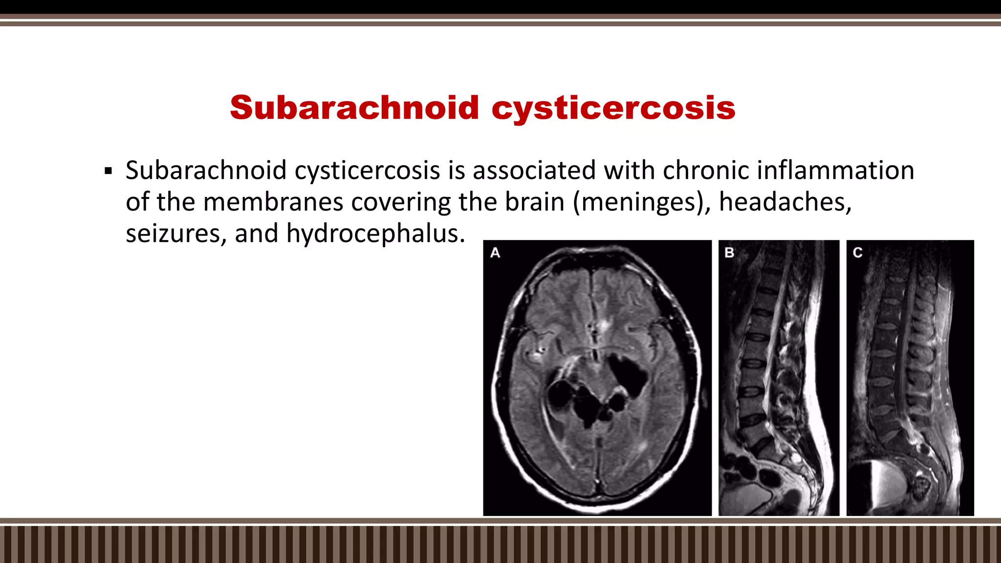 Cysticercosis -types symptoms| management |prevention (medical notes ...