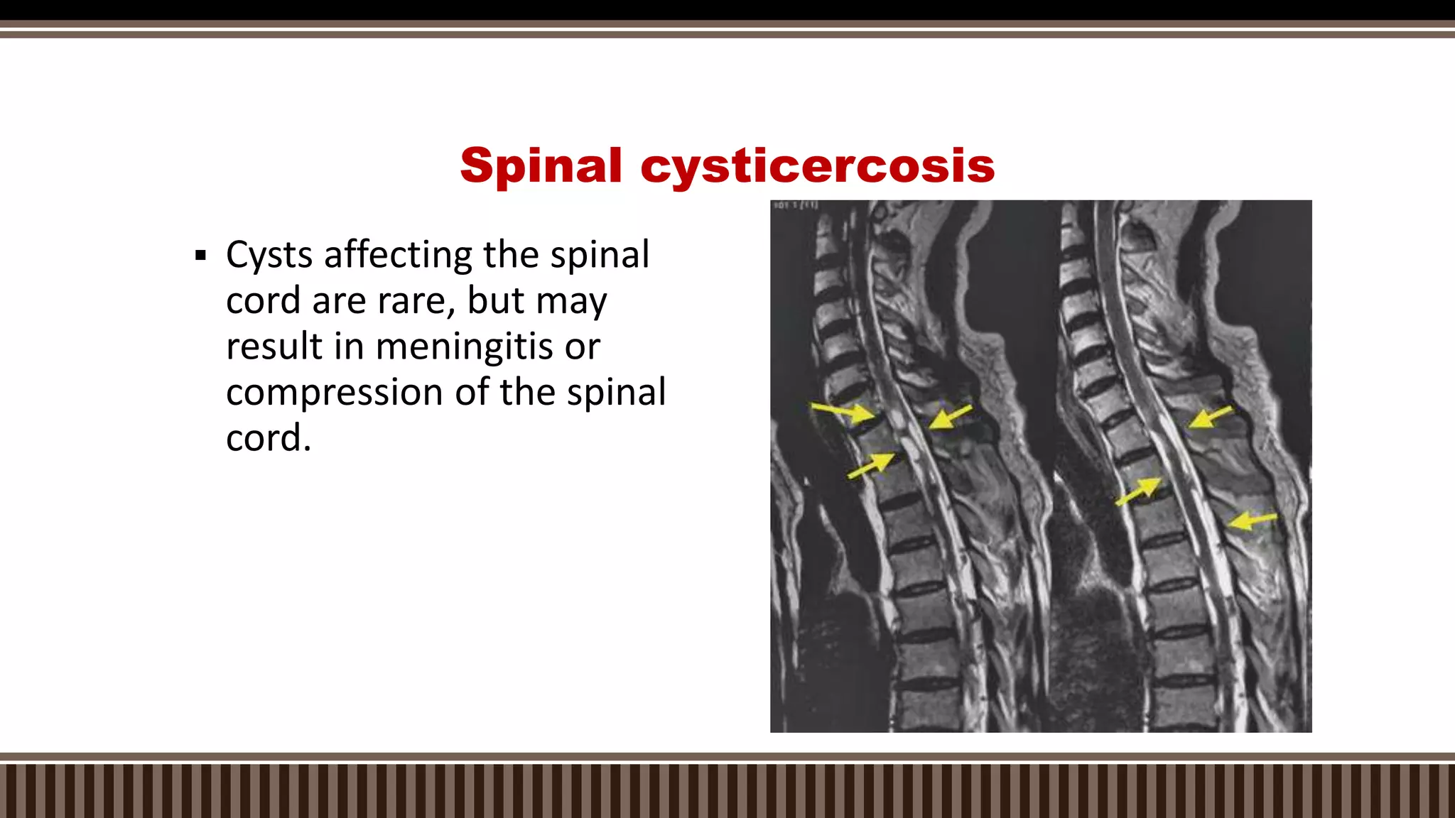 Cysticercosis -types symptoms| management |prevention (medical notes ...