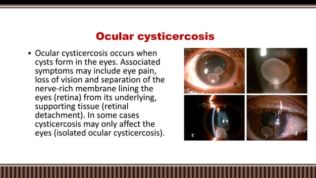 Cysticercosis -types symptoms| management |prevention (medical notes ...