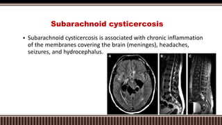 Cysticercosis -types symptoms| management |prevention (medical notes ...