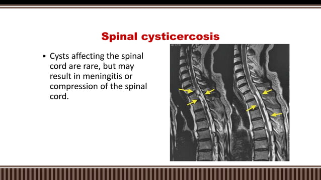 Cysticercosis -types symptoms| management |prevention (medical notes ...