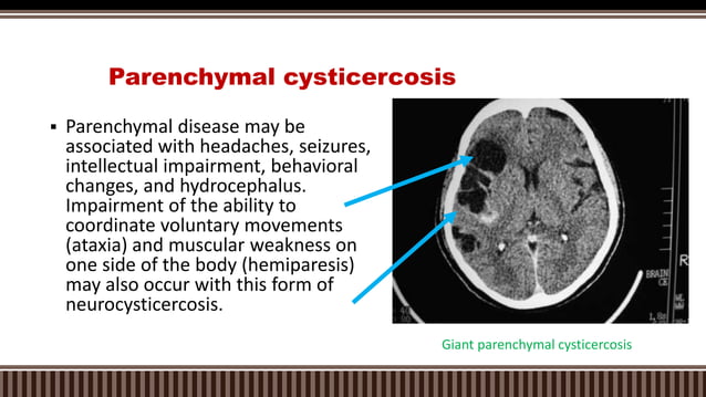 Cysticercosis -types symptoms| management |prevention (medical notes)