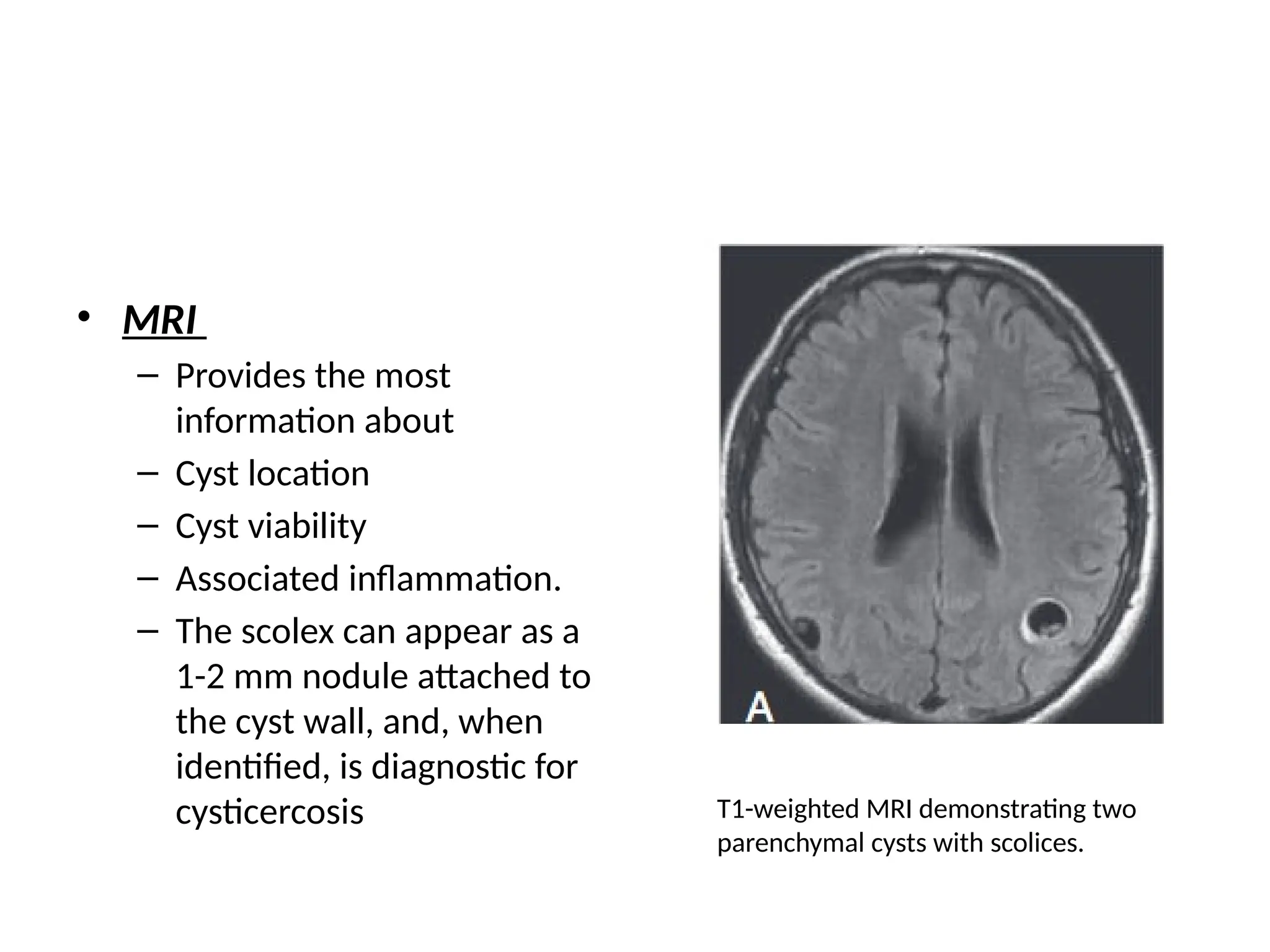 Cysticercosis diagnosis & management.pptx