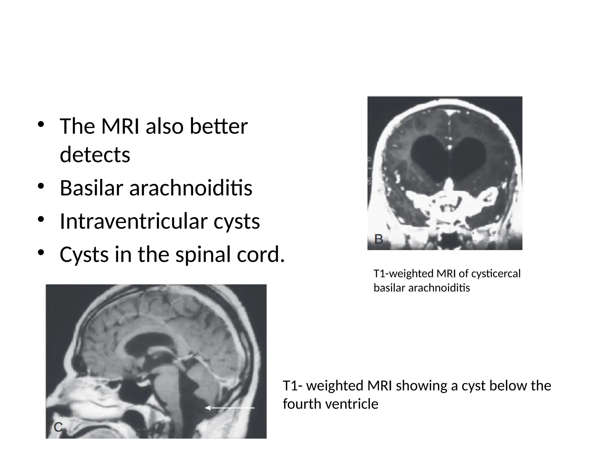 Cysticercosis diagnosis & management.pptx
