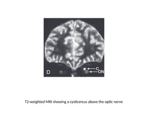 Cysticercosis diagnosis & management.pptx