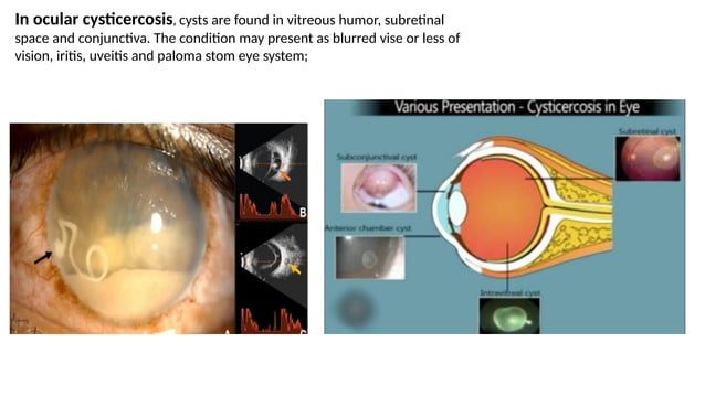 cysticercosis for medical student ........ | PPTX