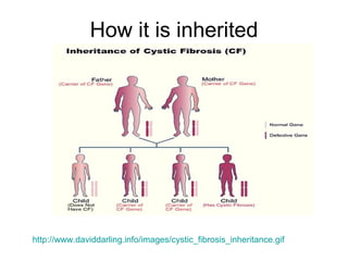 Cystic fibrosis | PPT