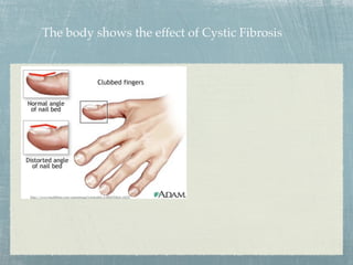 Info about Cystic fibrosis | KEY