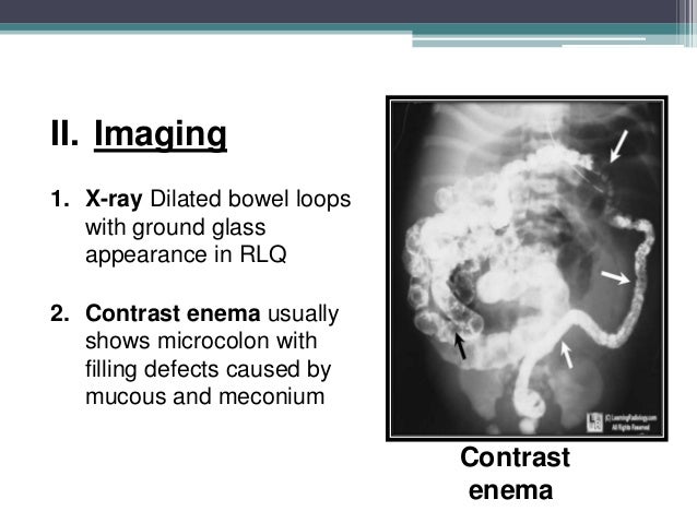 Yellow Stool Cystic Fibrosis