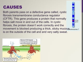 Cysticfibrosis | PPT