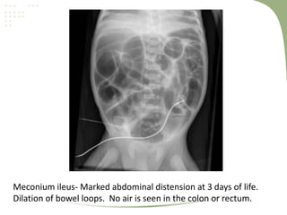 Paediatric Cystic Fibrosis | PPTX