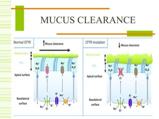 CYSTIC FIBROSIS | PDF