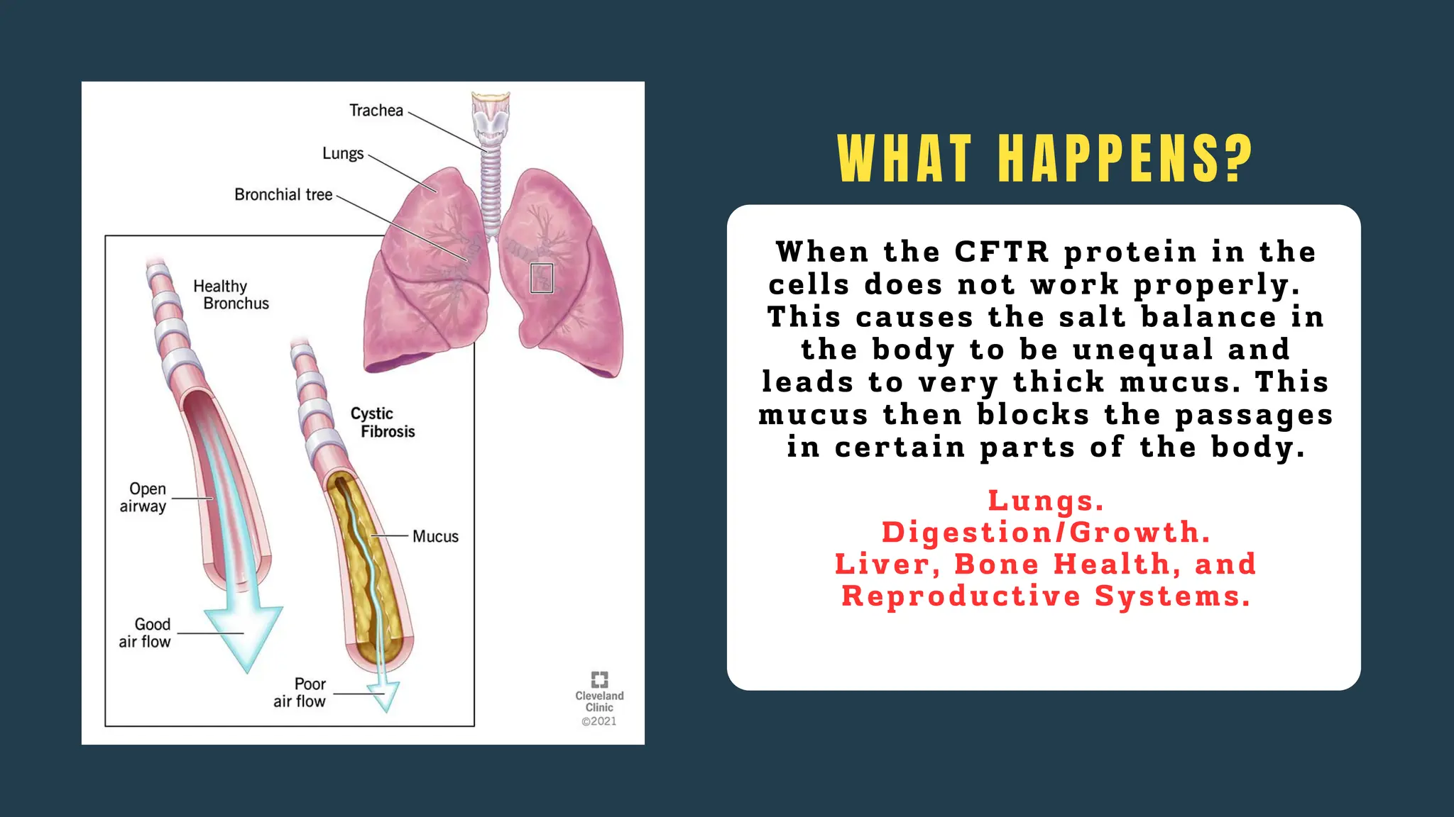 Cystic fibrosis.pdf
