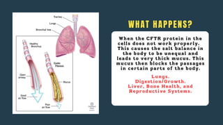 Cystic fibrosis.pdf