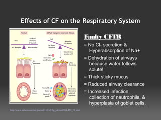 Cystic fibrosis[1] | ODP