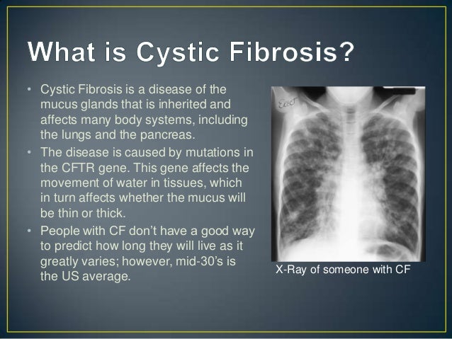 Cystic fibrosis[1]