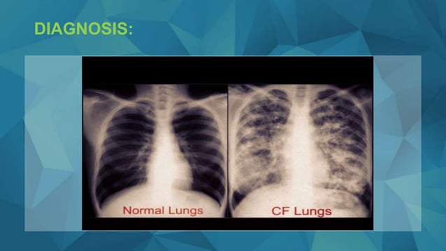CYSTIC FIBROSIS(1)respiratorysystem (1).pptx