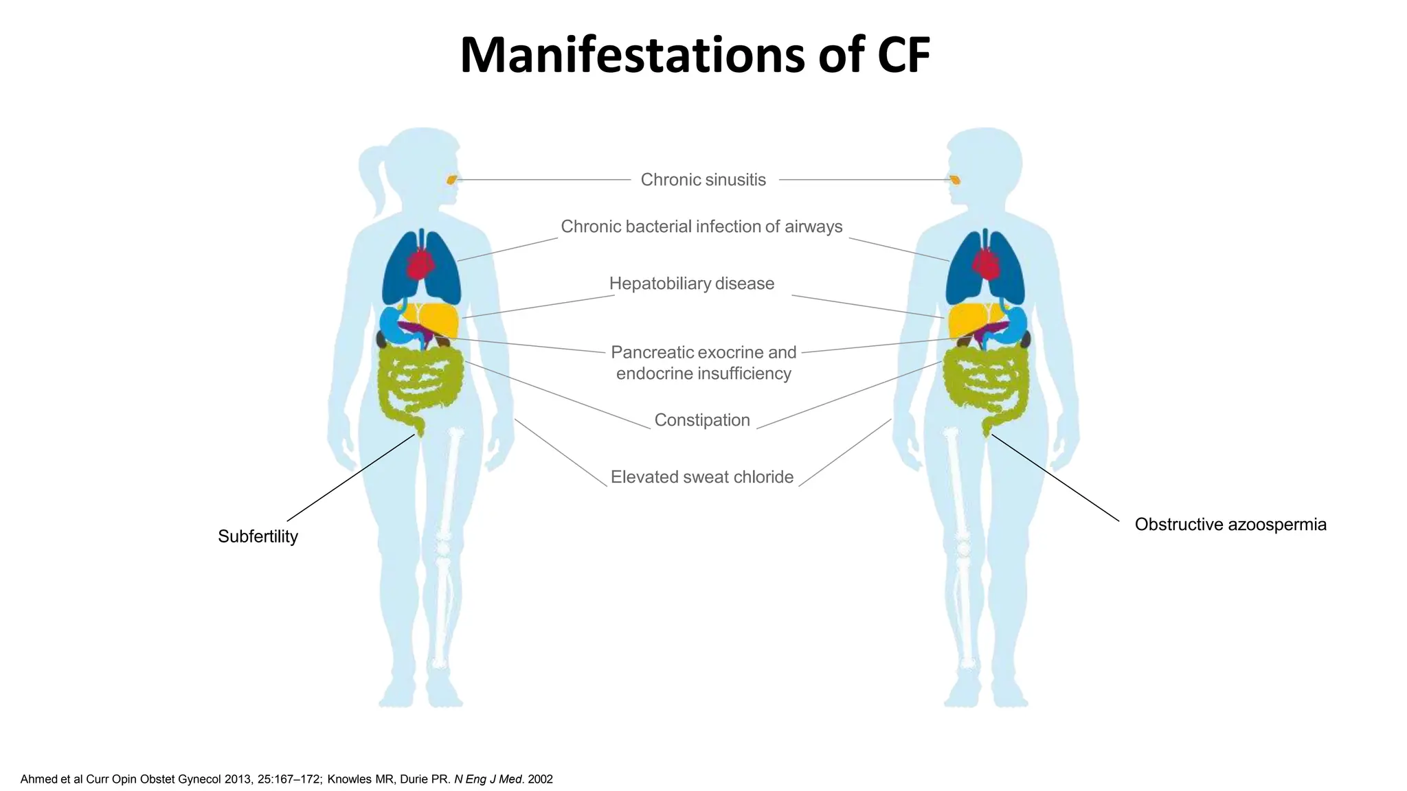 Gene therapy in the treatment of Cystic Fibrosis Dina Done.pptx