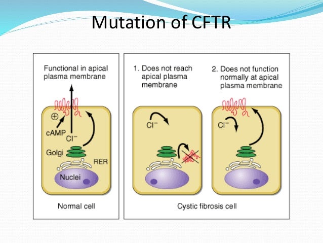 Cystic fibrosis(genetic disease)