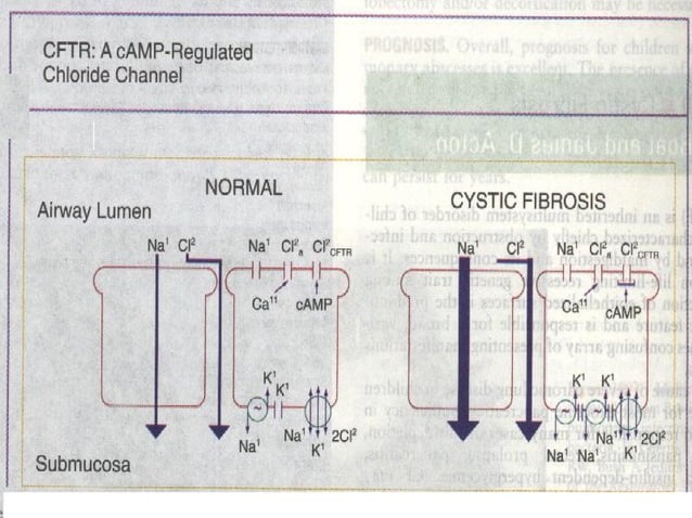 Cystic fibrosis | PPT