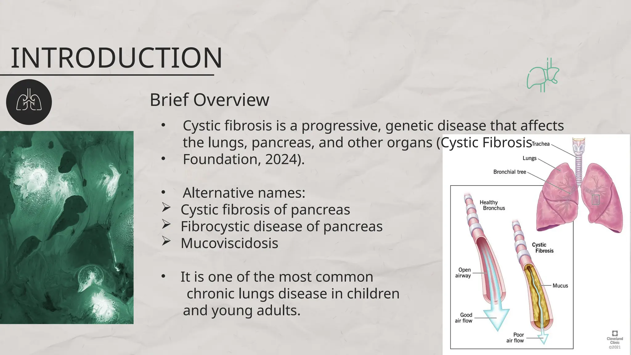 Cystic Fibrosis PPT PRESENTATION PATHOPHYSIOLOGY EIDEMICS, TREATMENT | PPTX