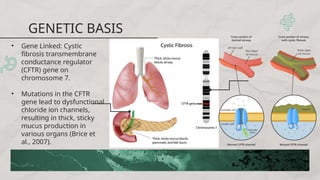 Cystic Fibrosis PPT PRESENTATION PATHOPHYSIOLOGY EIDEMICS, TREATMENT | PPTX