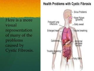 Cystic Fibrosis Presentation | PPTX