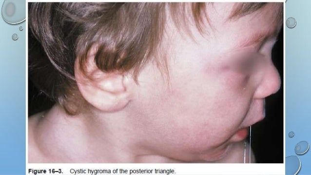 Cystic hygroma