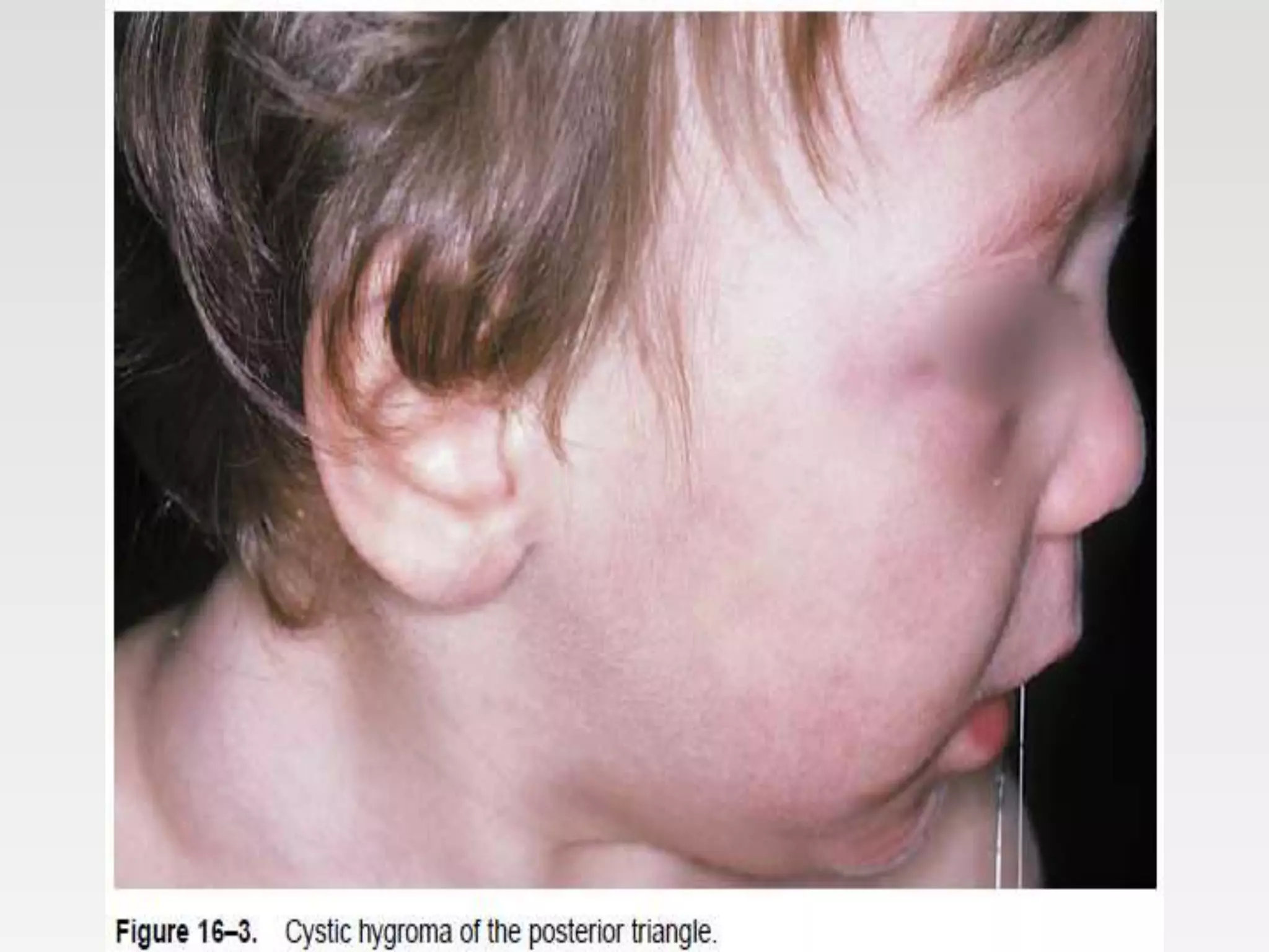 Cystic hygroma.pptx