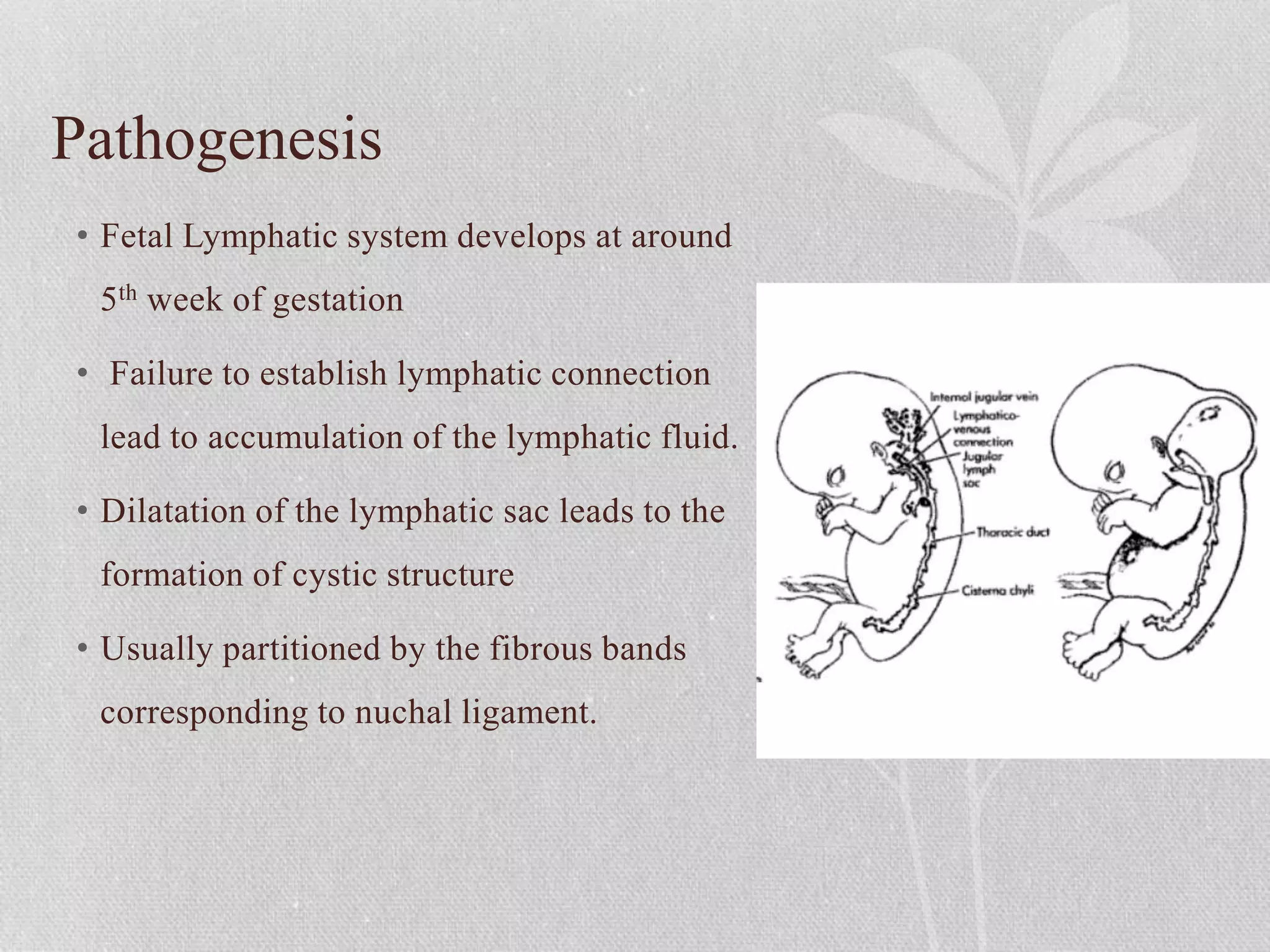 Cystic hygroma dt-2 | PPTX
