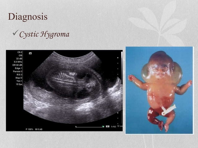 Cystic hygroma dt-2 | PPTX | Pregnancy | Reproductive Health