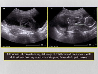 Cystic Hygroma Ultrasound