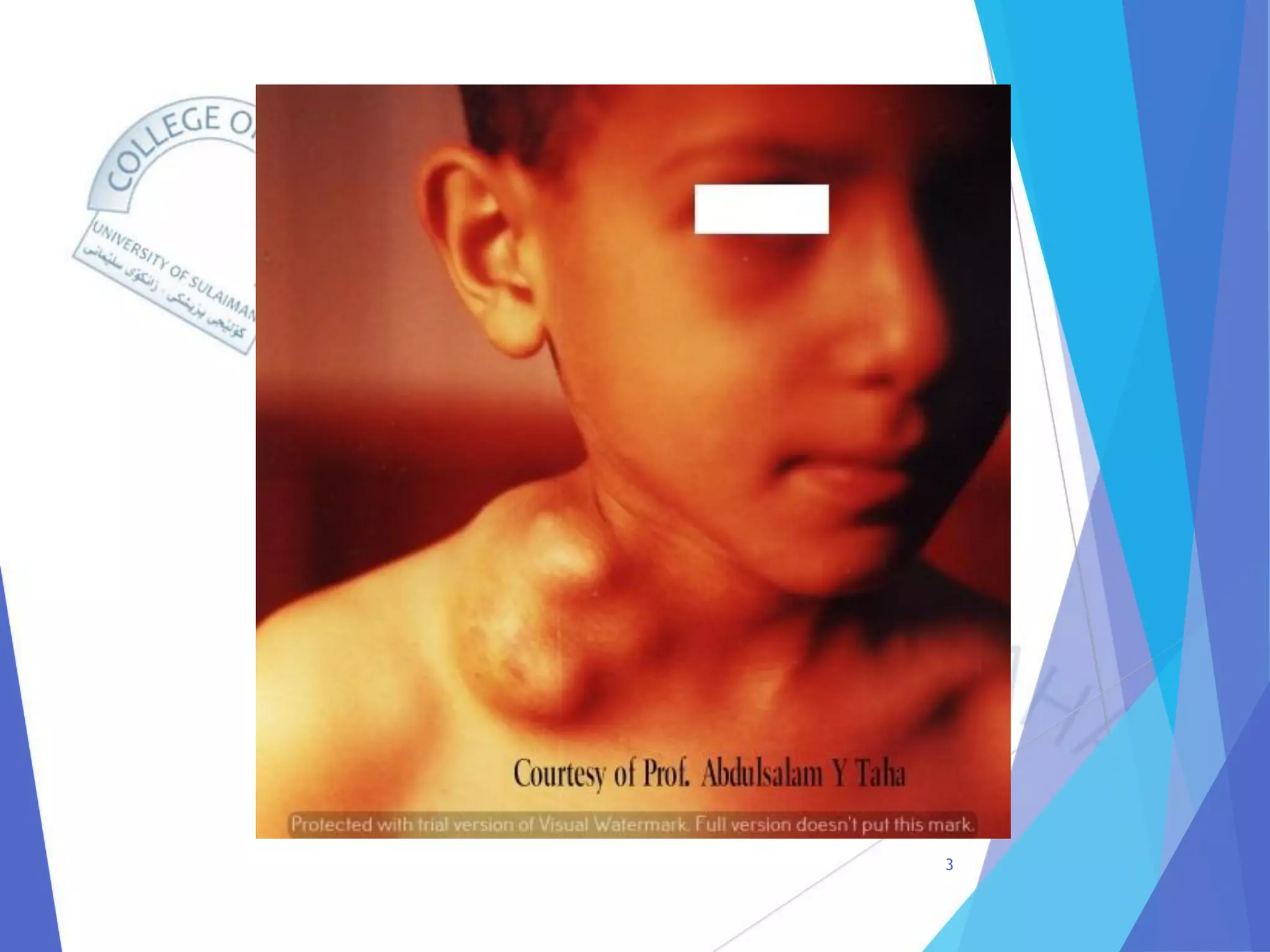 Cystic Hygroma of the Neck in a Child.pdf