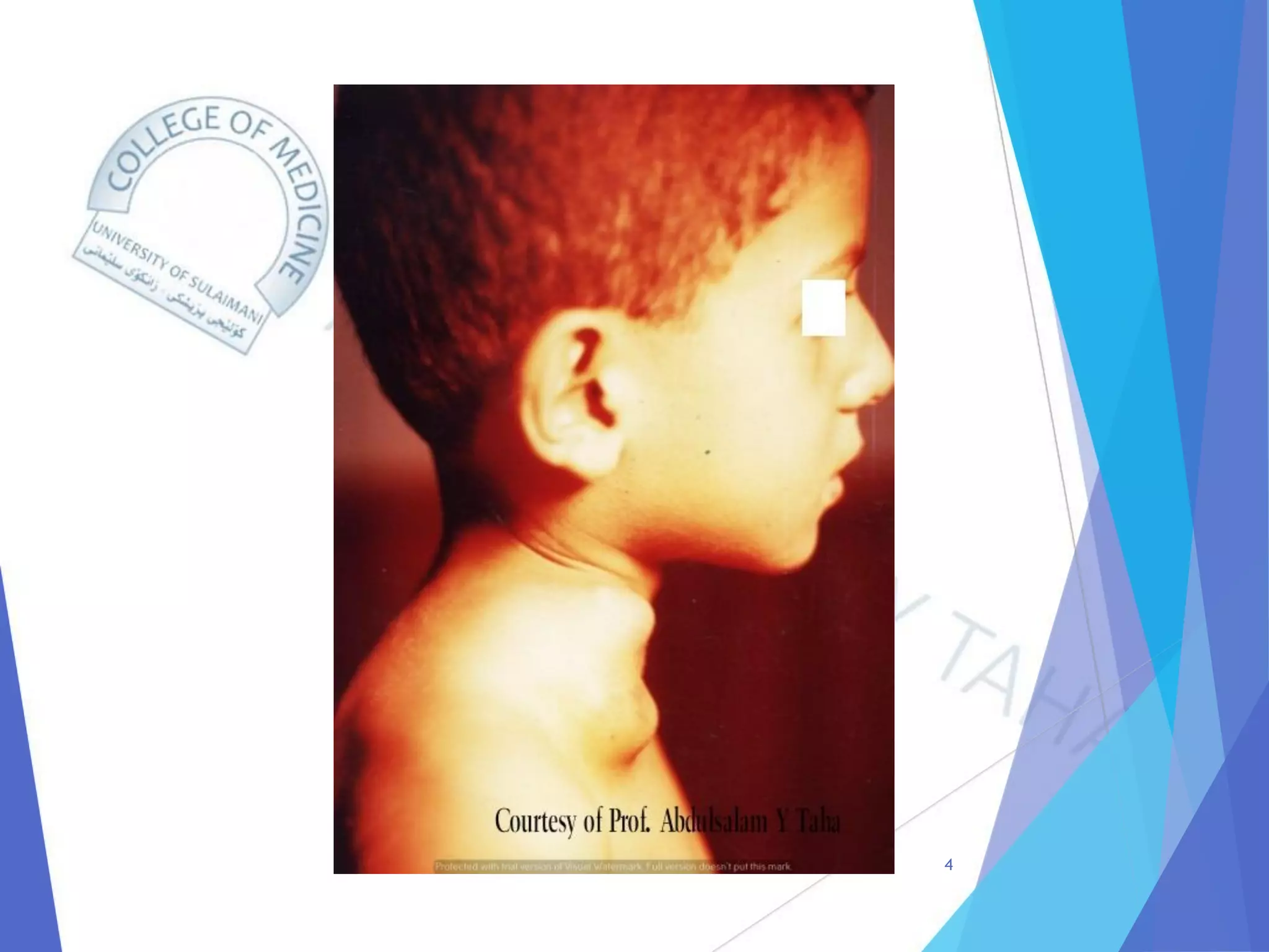 Cystic Hygroma of the Neck in a Child.pdf