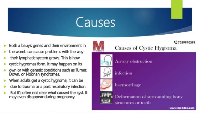 Cystic Hygroma ppt.pptx