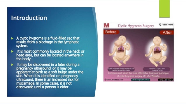 Cystic Hygroma ppt.pptx