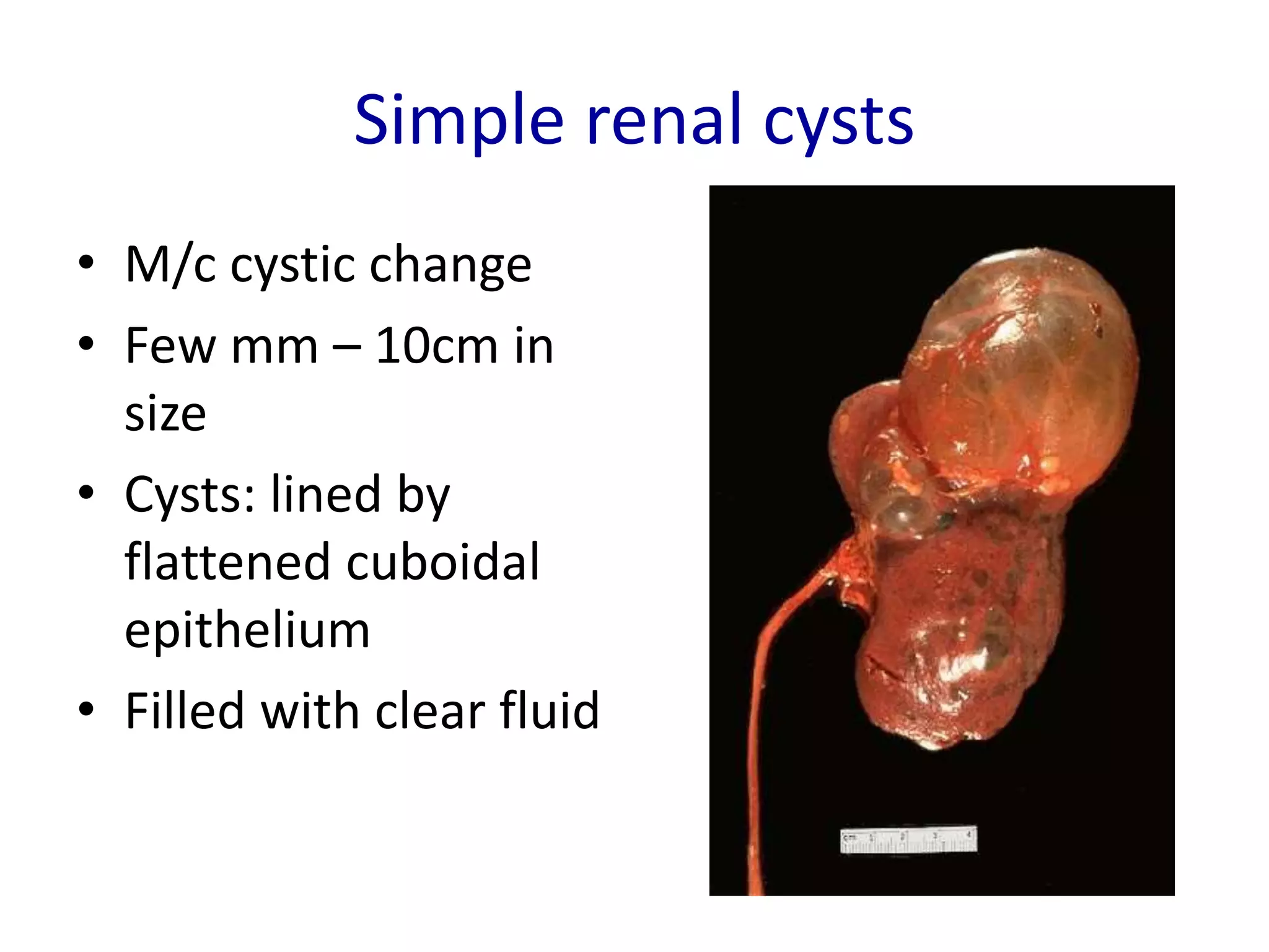 cystic kidney.pptx