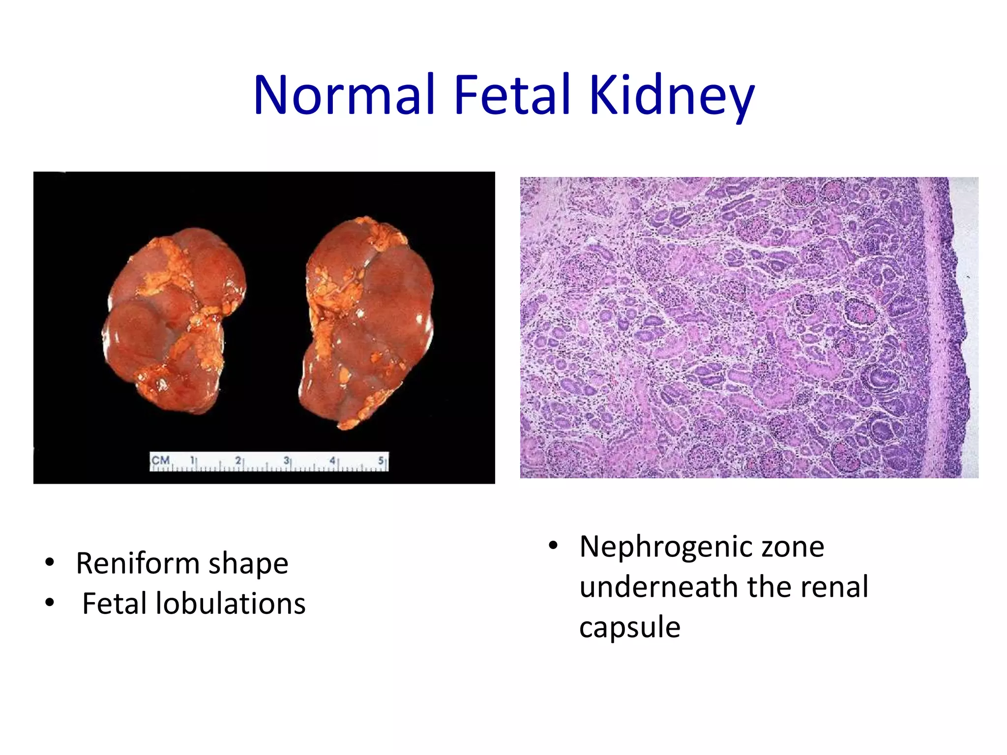 cystic kidney.pptx | Genetics | Science