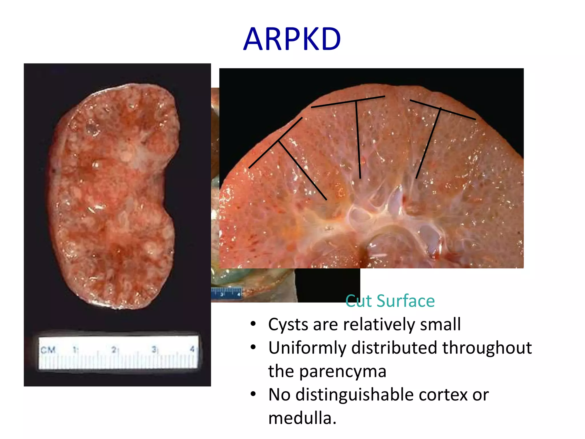 cystic kidney.pptx