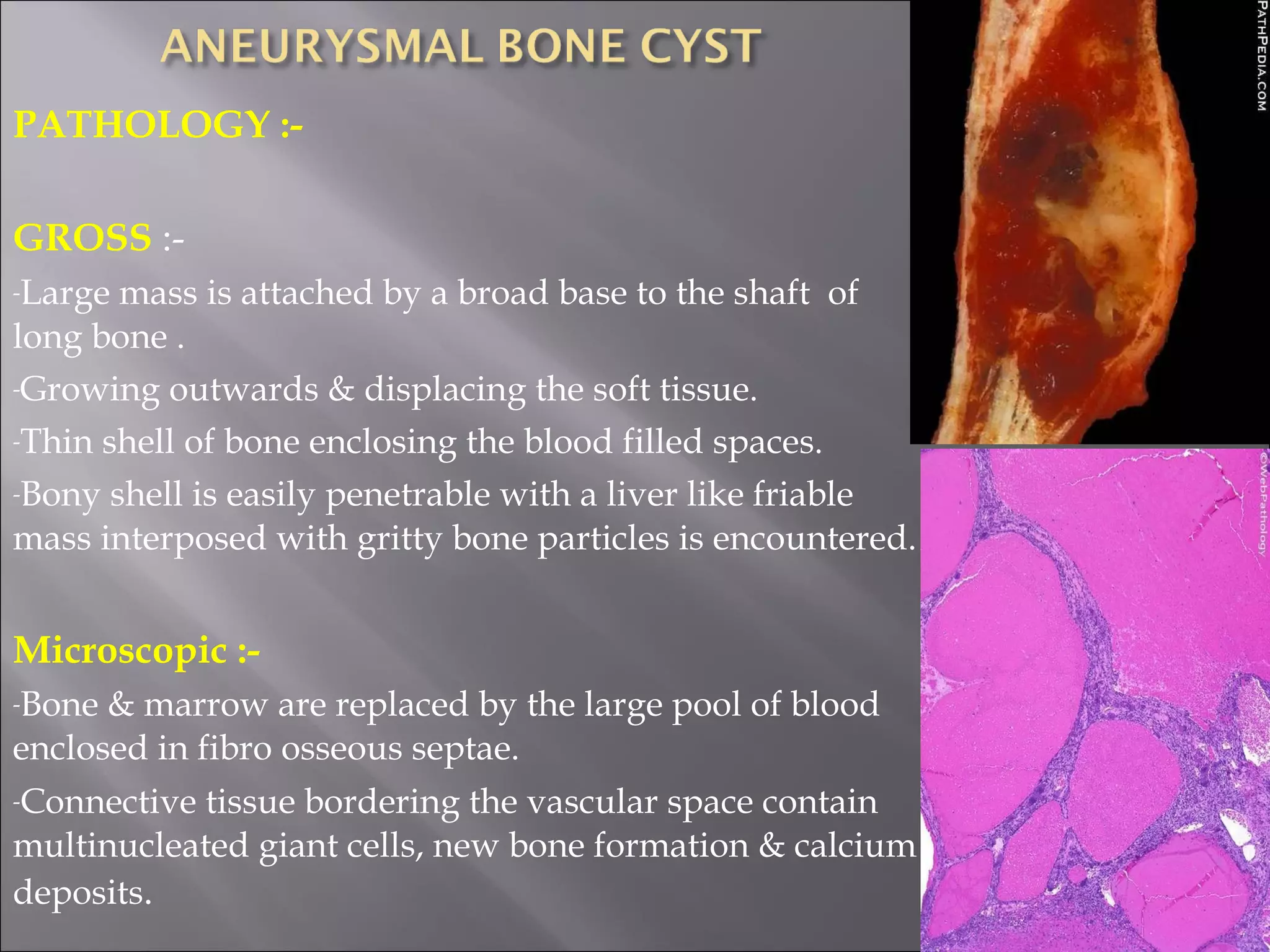 Cystic lesion of bones | PPT