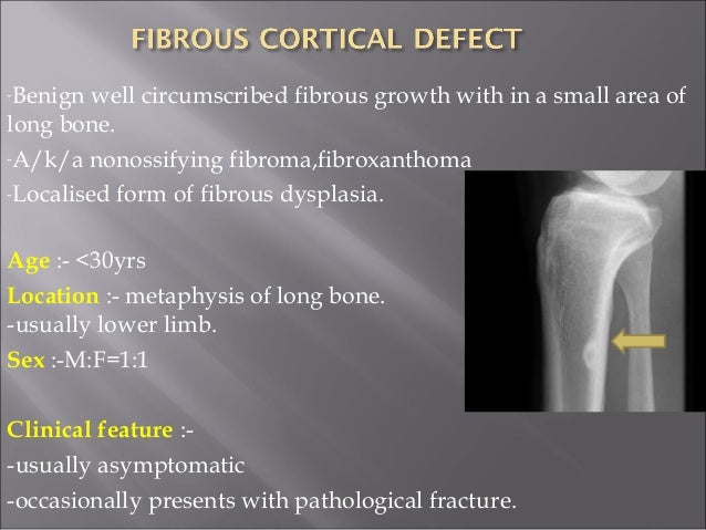 Cystic lesion of bones